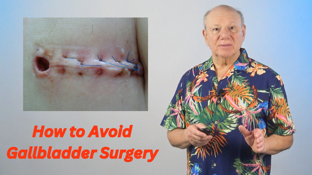 How to Avoid Gallbladder Surgery – Dr Baritz